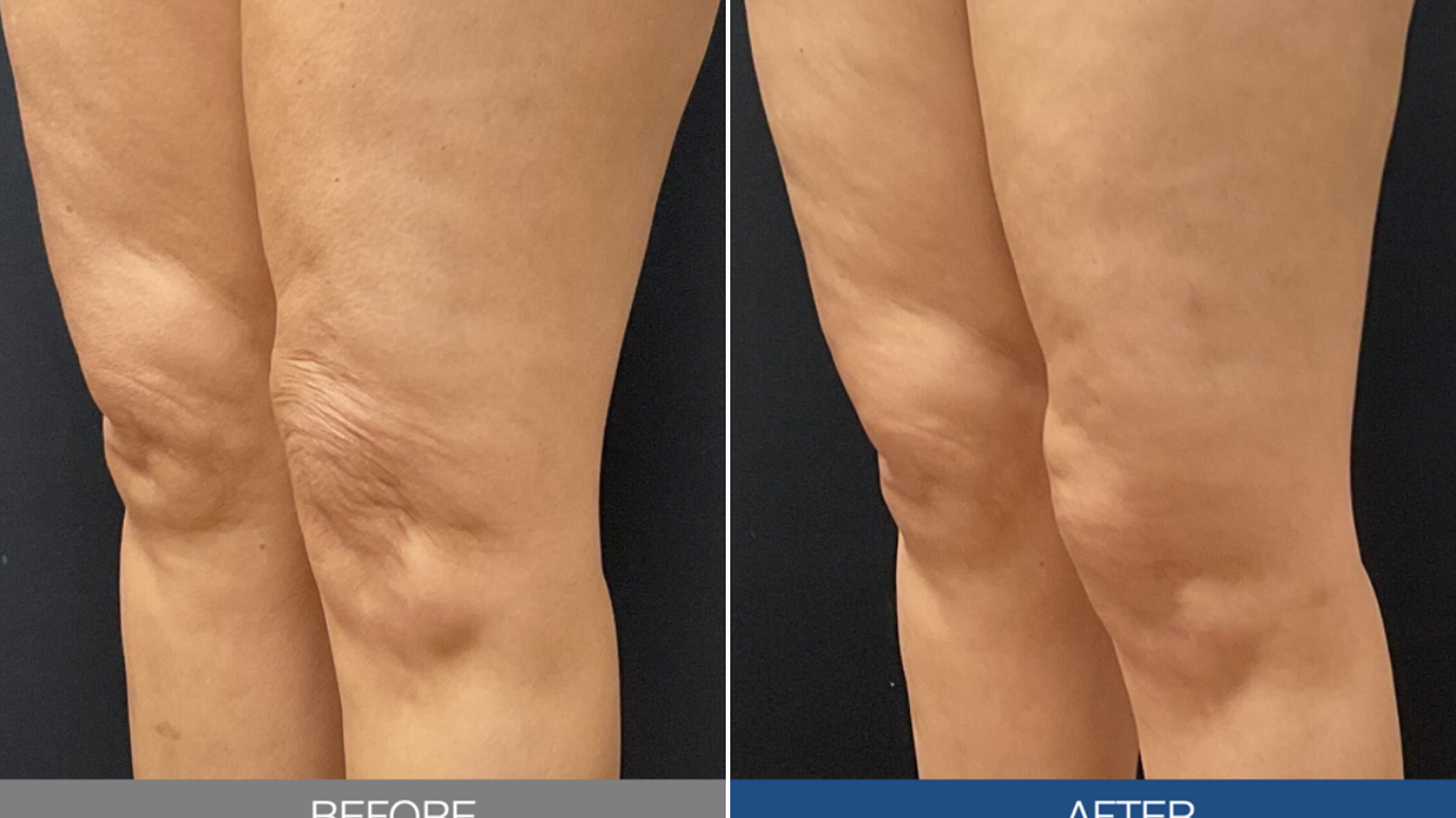 High-Density Ultrasound Handpiece Shows Promise in Cellulite Treatment ...