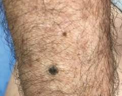 Know Your Lesions: The Many Variations of Seborrheic Keratosis