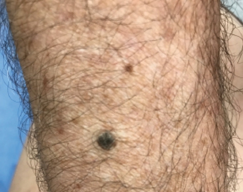 Know Your Lesions: The Many Variations of Seborrheic Keratosis