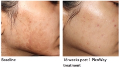 Treatment Guidelines for the PicoWay® Laser System in Skin of Color