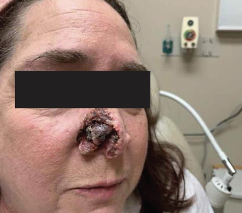 Basosquamous Carcinoma: A Case Series
