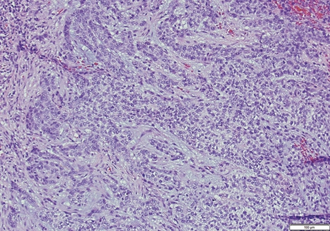 Basosquamous Carcinoma: A Case Series