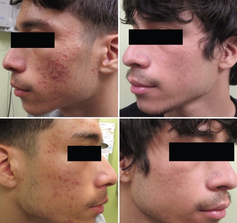 Laser Therapy for Atrophic Acne Scars: A Case and Evidence-based Updates