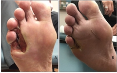 Verrucous Carcinoma of the Foot