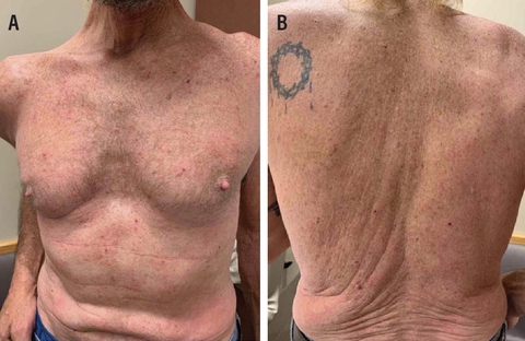 Dupilumab For the Management of Pembrolizumab-induced Rash: A Case Report