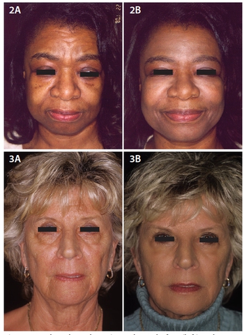 PRP: What Dermatologists Should Know