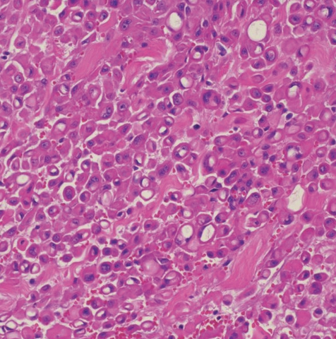 Cutaneous Signet Ring Squamous Cell Carcinoma: Case Presentation and ...