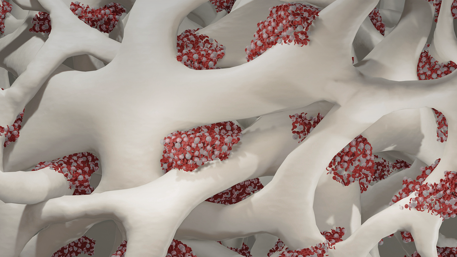 From MGUS to Multiple Myeloma: Understanding the Progression of ...