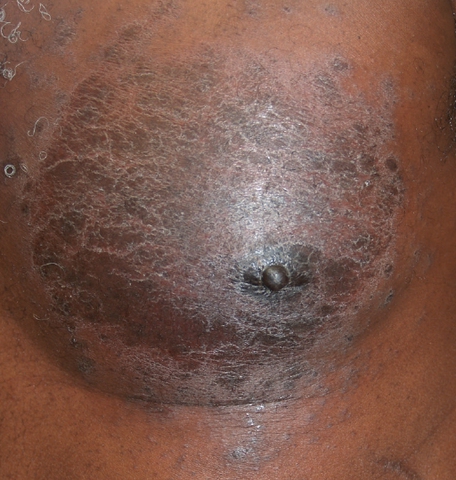 Diagnosing Allergic Contact Dermatitis