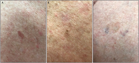 Know Your Lesions: The Many Variations of Seborrheic Keratosis