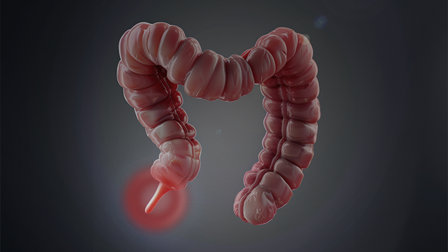 The Role of Antibiotics in Acute Uncomplicated Appendicitis Treatment ...