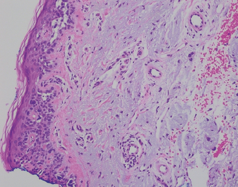 Incidental Invasive Melanoma Discovered During Excision Of Basal Cell ...