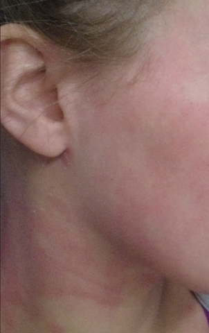 Case Report: First Reported Case of Facial Rash After Dupilumab Therapy ...
