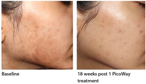 Treatment Guidelines for the PicoWay® Laser System in Skin of Color