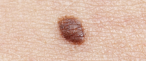 What’s New in Nonmelanoma Skin Cancer Treatment?