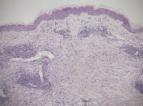 Proton Pump Inhibitor-induced Dermal Hypersensitivity Reaction ...