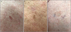 Know Your Lesions: The Many Variations of Seborrheic Keratosis