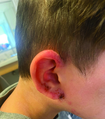 Disseminated Varicella Zoster Virus and Herpes Zoster Virus Infection ...