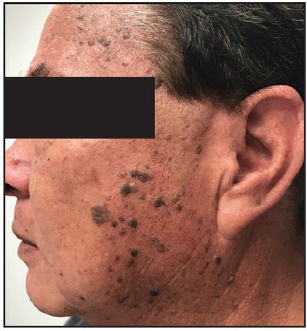New Options for the Treatment of Extensive Seborrheic Keratosis