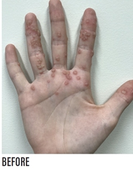 A Rational Criteria: When Not to Treat Warts