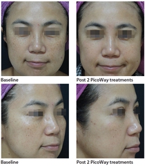 Treatment Guidelines for the PicoWay® Laser System in Skin of Color