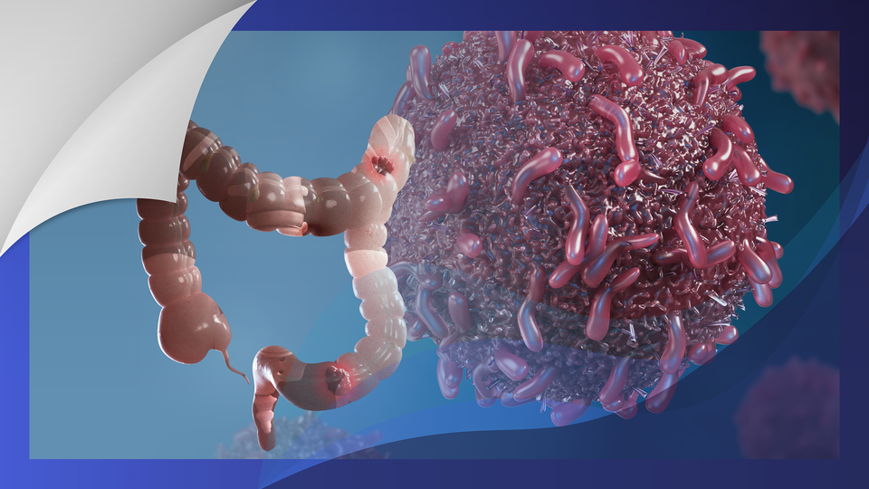 Examining the Role of Bacterial Biofilms in Colorectal Cancer Screening ...
