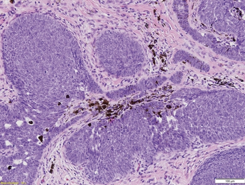Basal Cell Carcinoma in Skin of Color: A Case Series