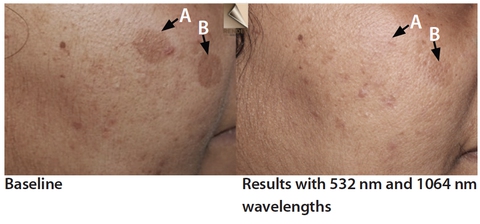 Treatment Guidelines for the PicoWay® Laser System in Skin of Color