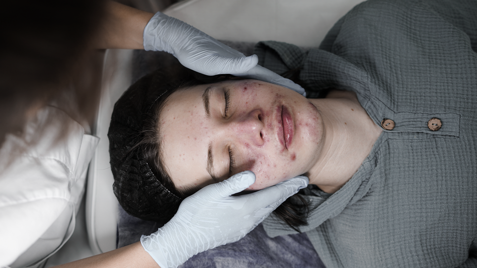 Evidence-Based Guidelines for Managing Acne: Updates from AAD Medical ...