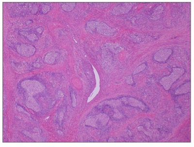 UNVEILING IgG4-RELATED DISEASE