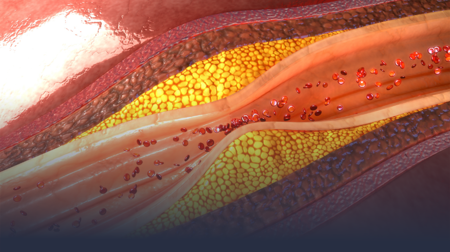 Mastering the Management of ASCVD Risk