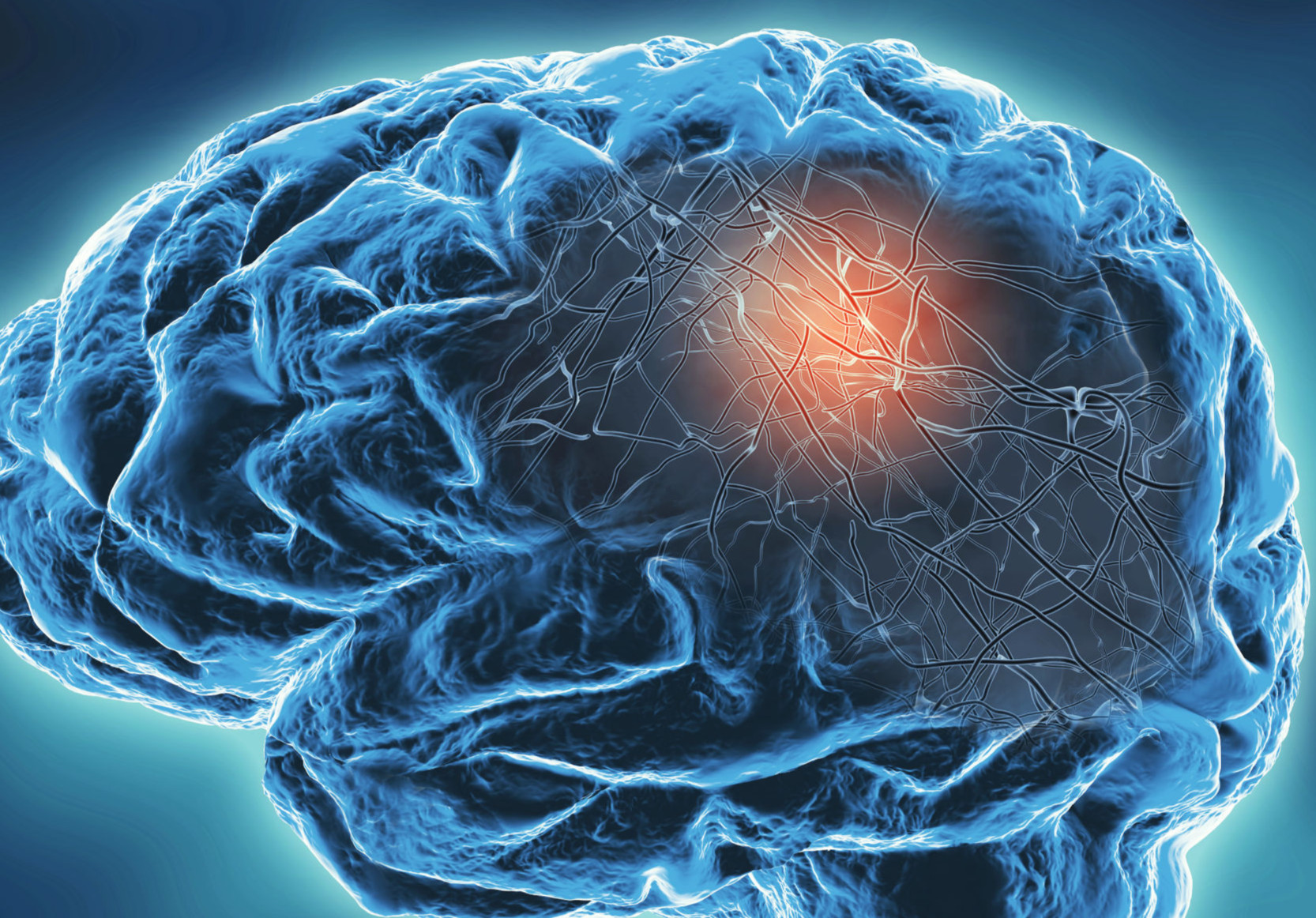 Visualizing Multiple Sclerosis with a New MRI Procedure - Be part of ...