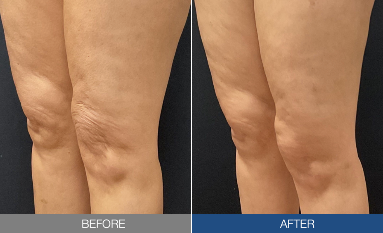 High-Density Ultrasound Handpiece Shows Promise in Cellulite Treatment ...