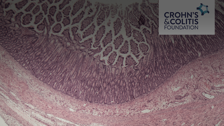 Virtual IBD Clinic Disease Management and Surgery