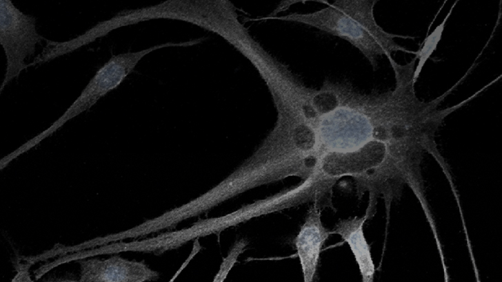 How are neurosurgeons managing eloquent brain tumors?