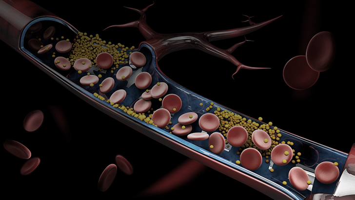 What are some risks of ASCVD in our female patients?