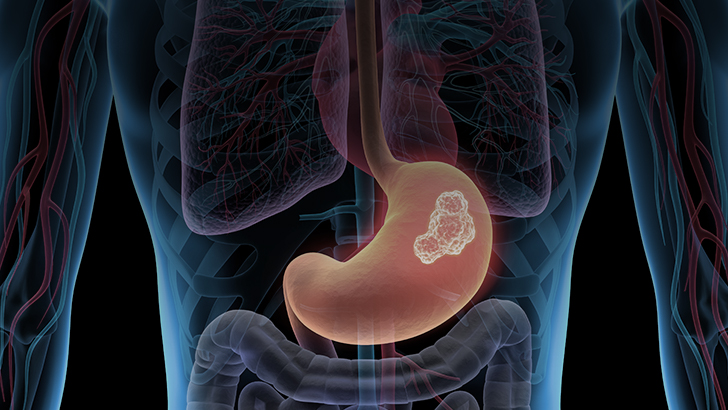 Gastric Cancer Screening & Surveillance Strategies