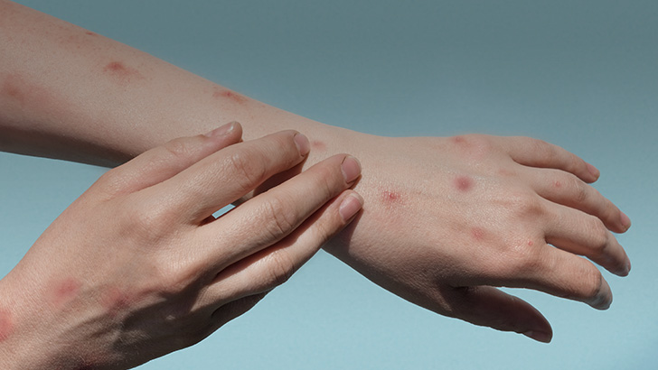 Monkeypox: A Guide for Dermatologists Amid a Global Outbreak Medical ...