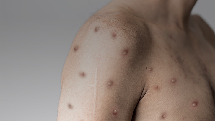 Strategies for Stopping the Spread of Monkeypox Medical Education on ...