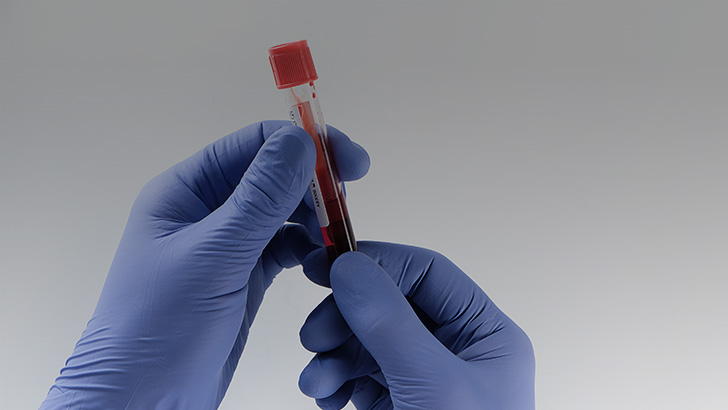 Exploring Novel Tools for PAH: Measuring Severity With a New Blood Test ...