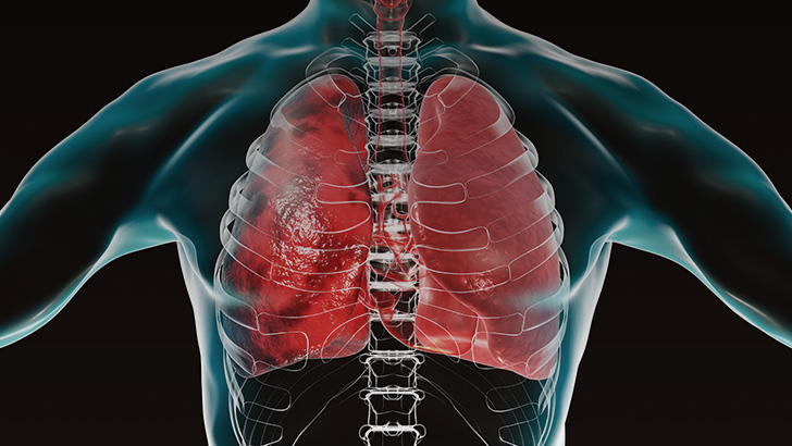 Pneumonia: A Look at Key Obstacles & New Testing Modalities