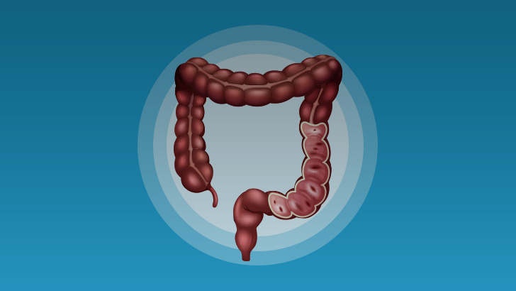 Key Considerations for Treating Ulcerative Colitis