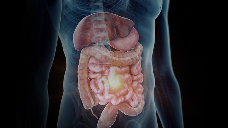 Key Insights on Endoscopic Strictures in Crohn’s Disease