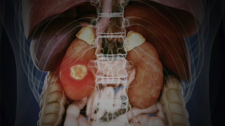 Taking a Deep Dive into the Pathophysiology of IgAN