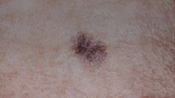 Reviewing the Role of B Cells in Melanoma Medical Education on ReachMD