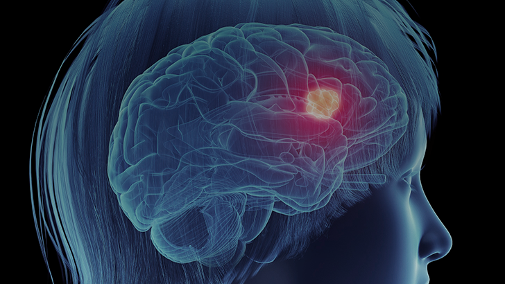 When Breast Cancer Spreads to the Brain: Diagnosis and Treatment ...