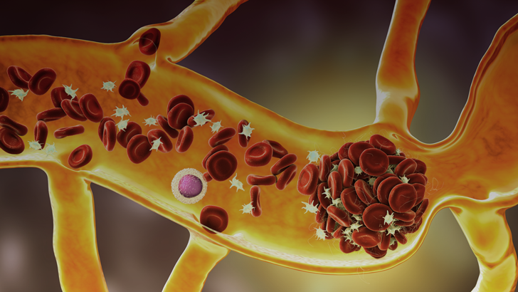 CME: Diagnosis & Treatment of Chronic Thromboembolic Pulmonary ... CME: Diagnosis & Treatment of Chronic Thromboembolic Pulmonary ...