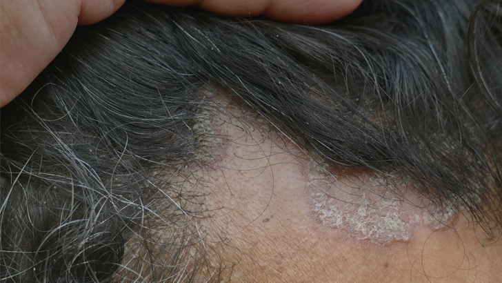 Post-Hoc Analysis of Scalp PsO Treatment After Five Years