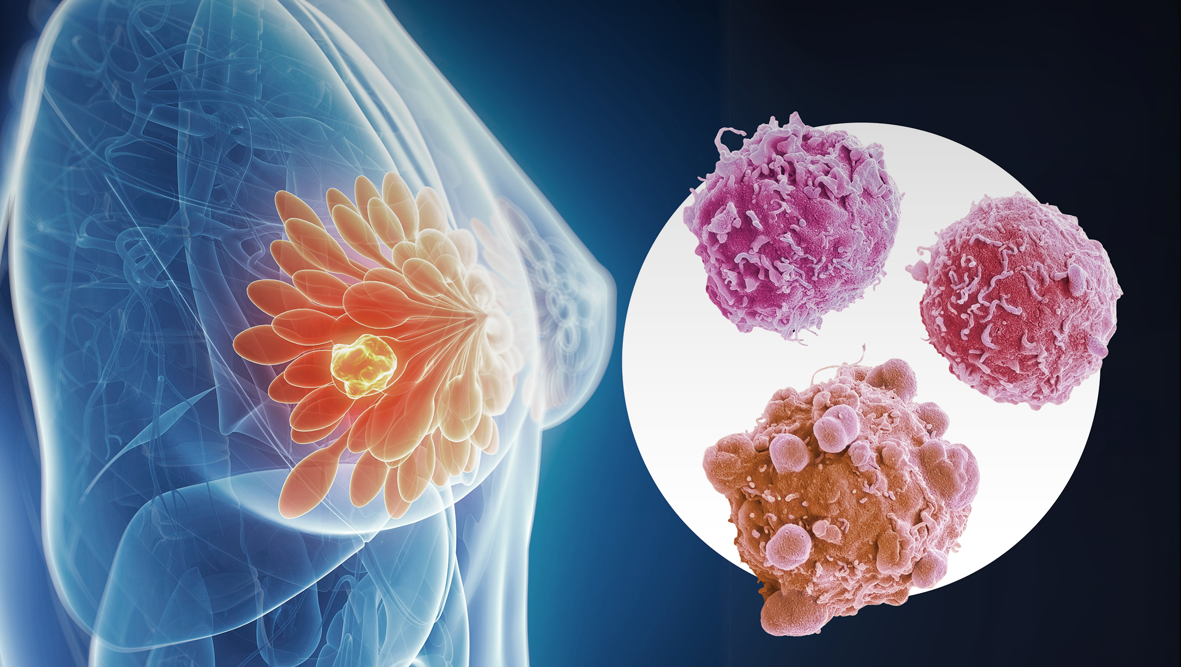 CME: breast cancer cells