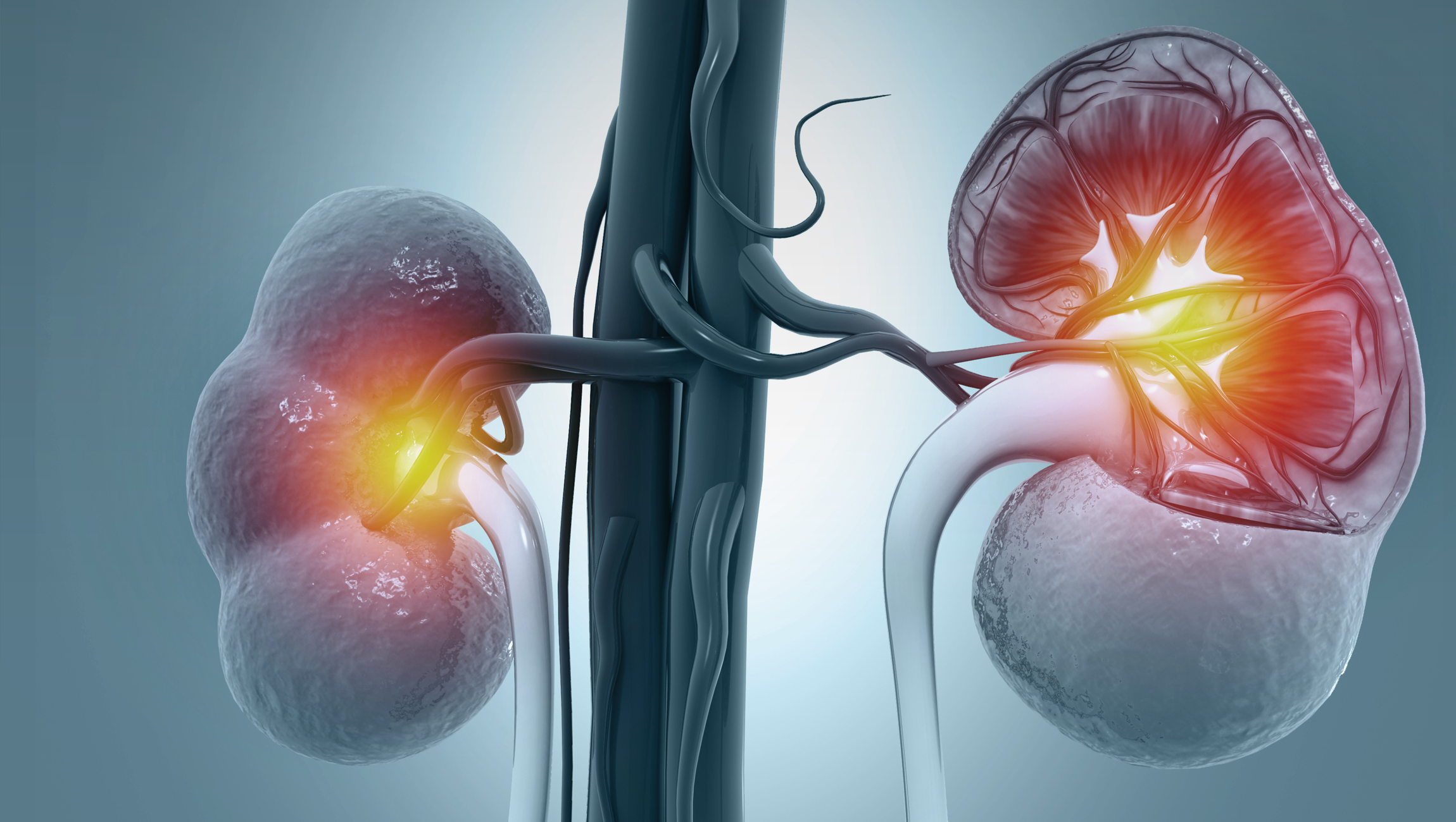 hyperphosphatemia, CKD, dialysis, tenapanor, NHE3 inhibitors